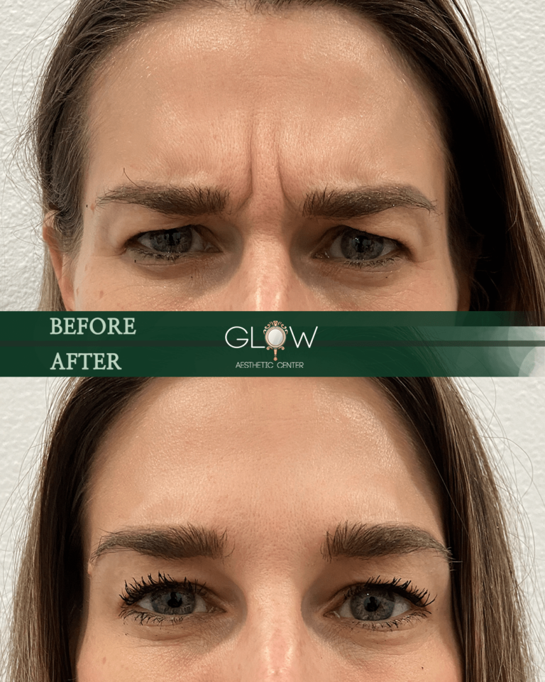 Botox | Glow Aesthetic Center