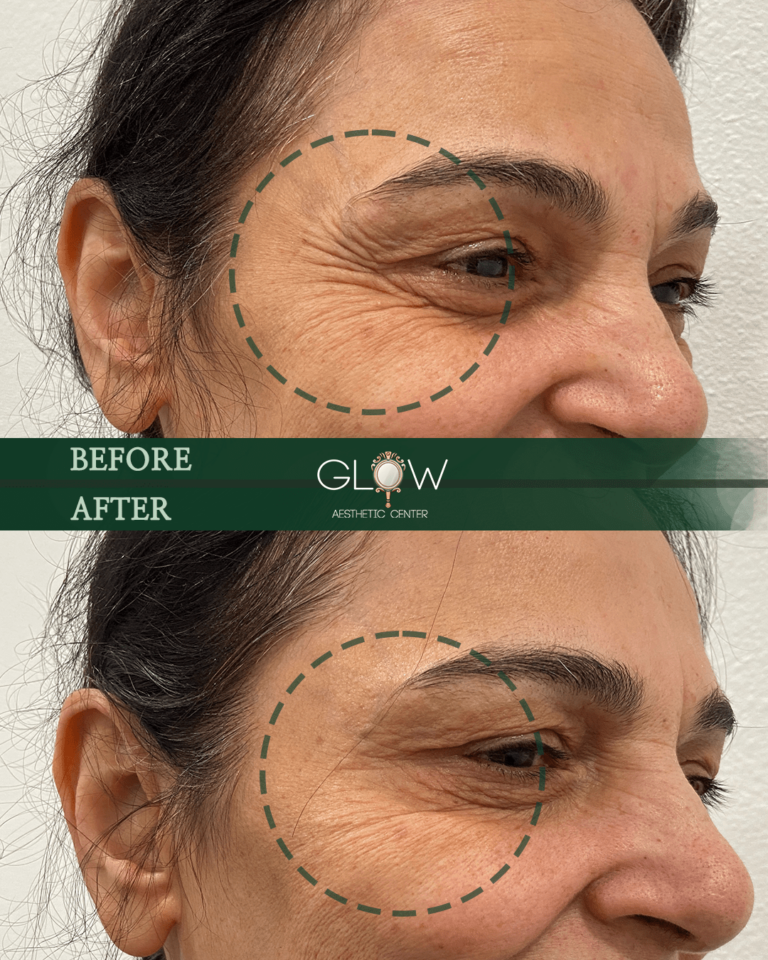 Encino Botox Treatment | Glow Aesthetic Center