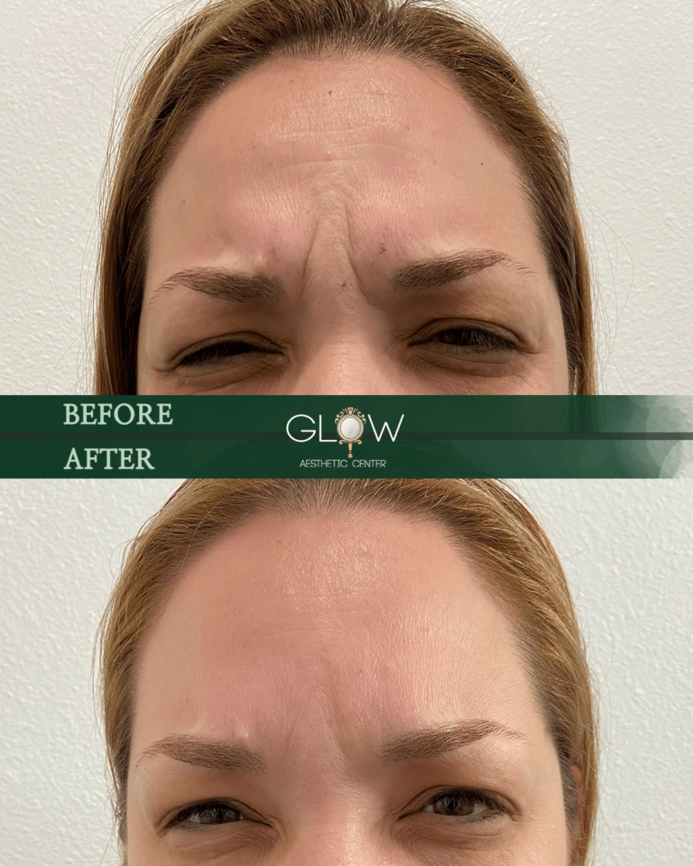 Botox | Glow Aesthetic Center