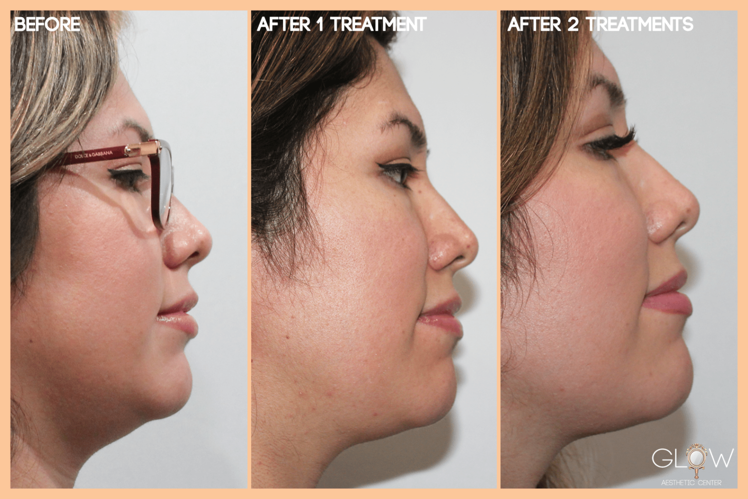 Botox | Glow Aesthetic Center