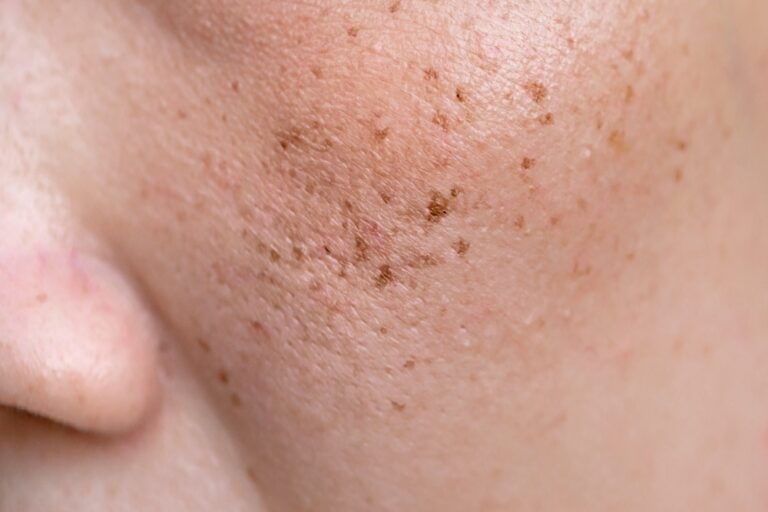 How Do You Know If You Have Skin Pigmentation? | Glow Aesthetic Center