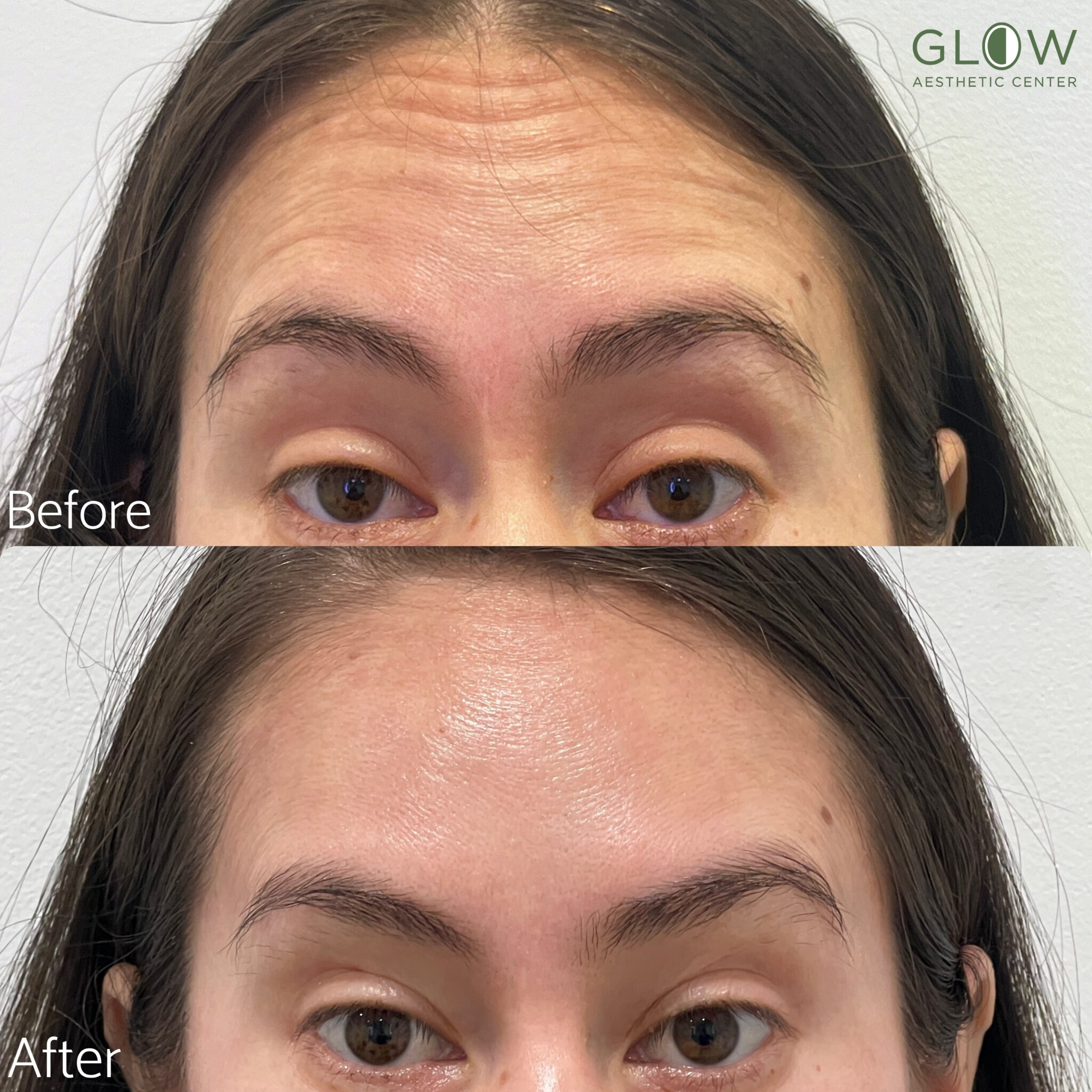 Botox Treatment in Encino, CA | Glow Aesthetic Center