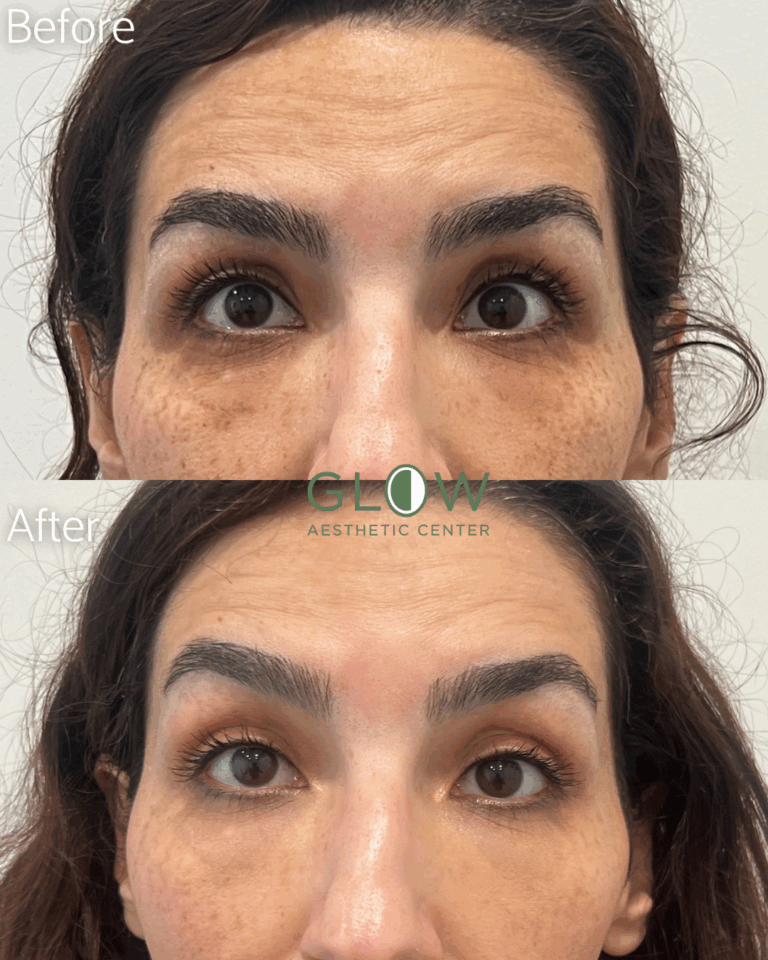 Botox Treatment in Encino, CA | Glow Aesthetic Center
