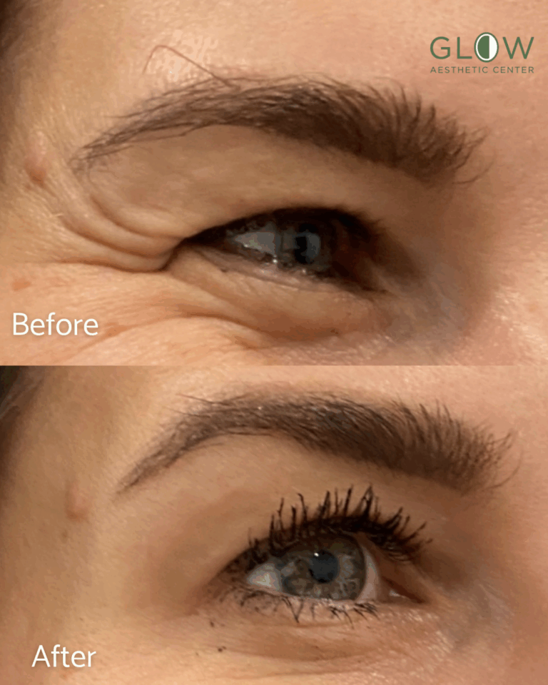 Botox Treatment in Encino, CA | Glow Aesthetic Center