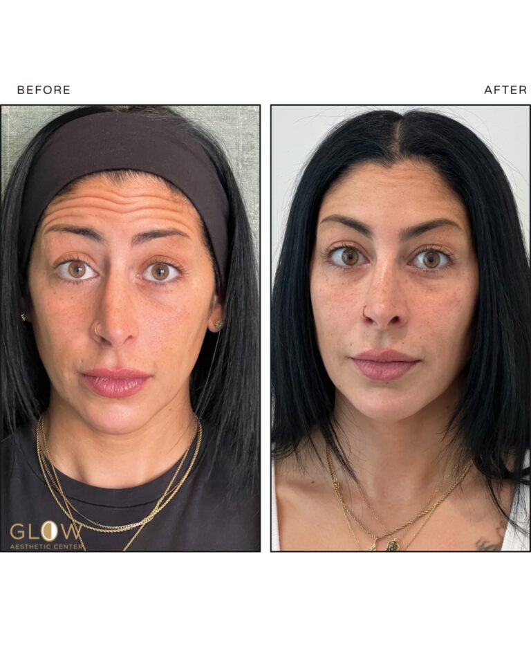 Botox Treatment in Encino, CA | Glow Aesthetic Center