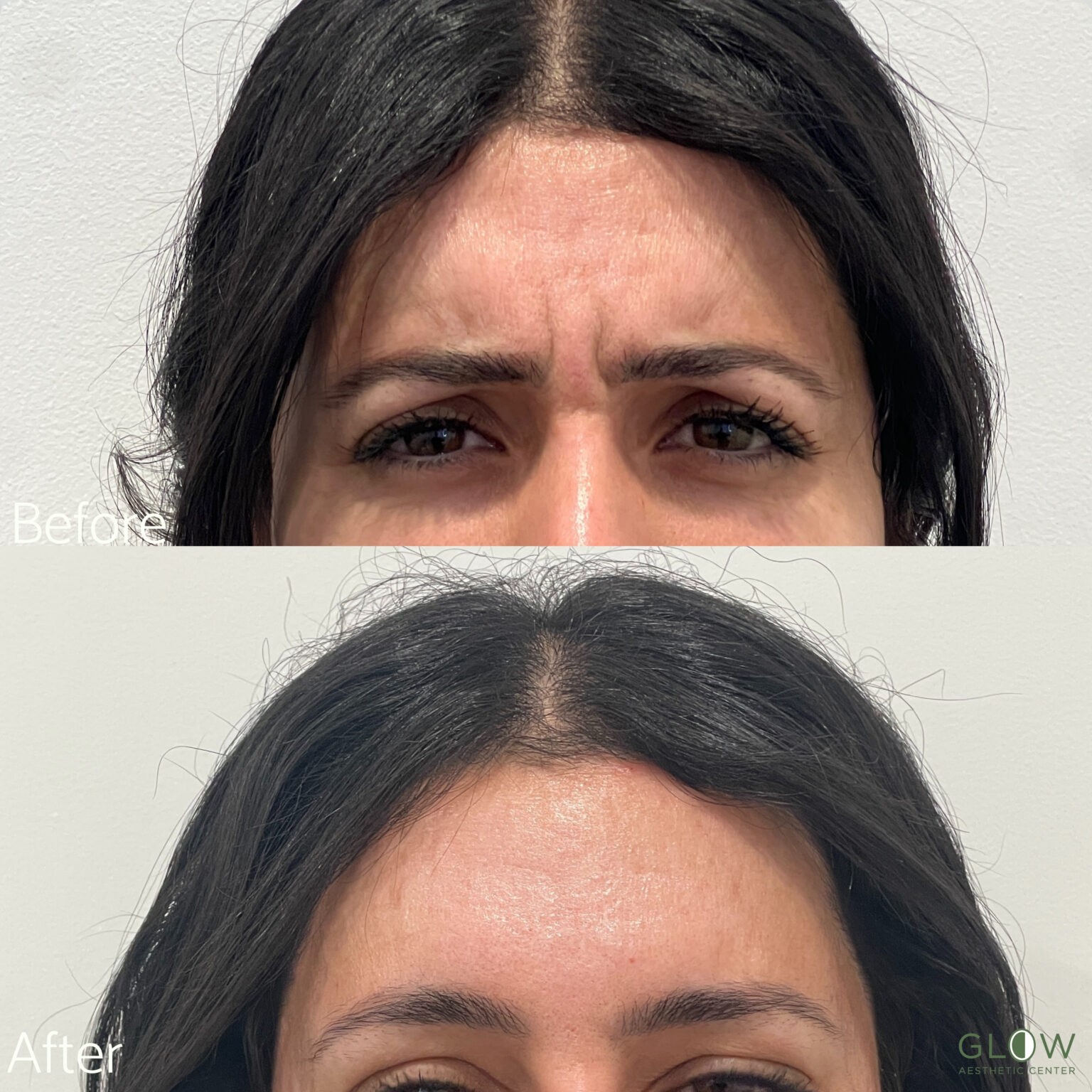 Botox Treatment in Encino, CA | Glow Aesthetic Center